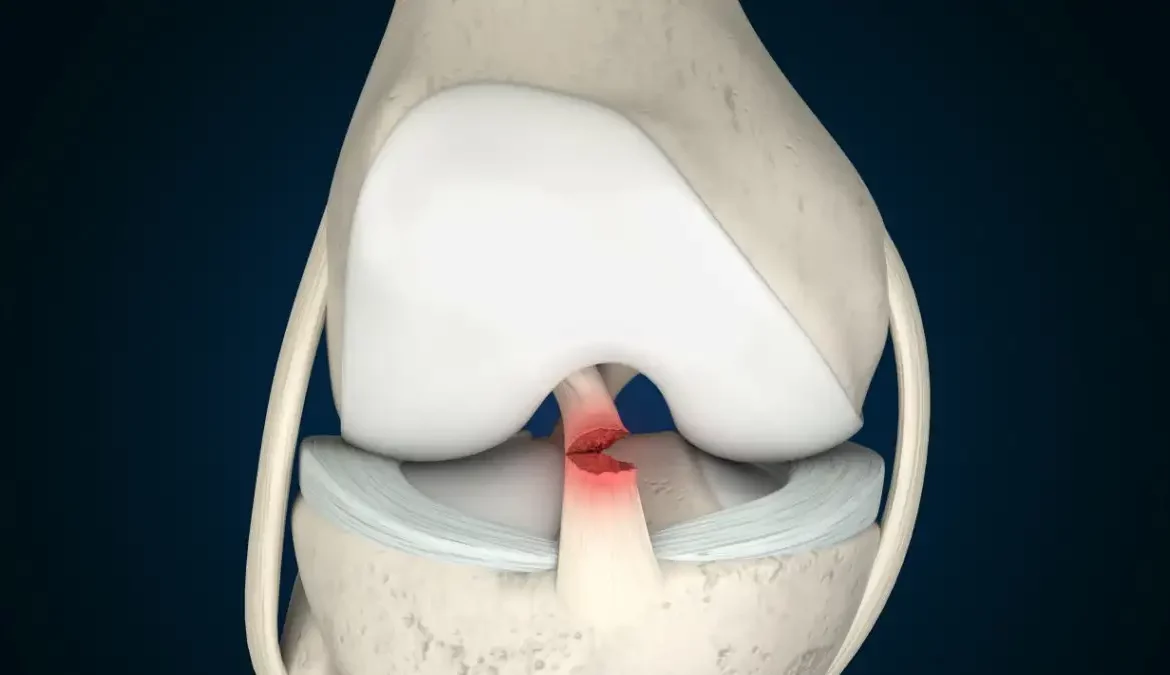 Ligamenti Kolena – Povrede, Simptomi i Lečenje - ZdravljeInfo